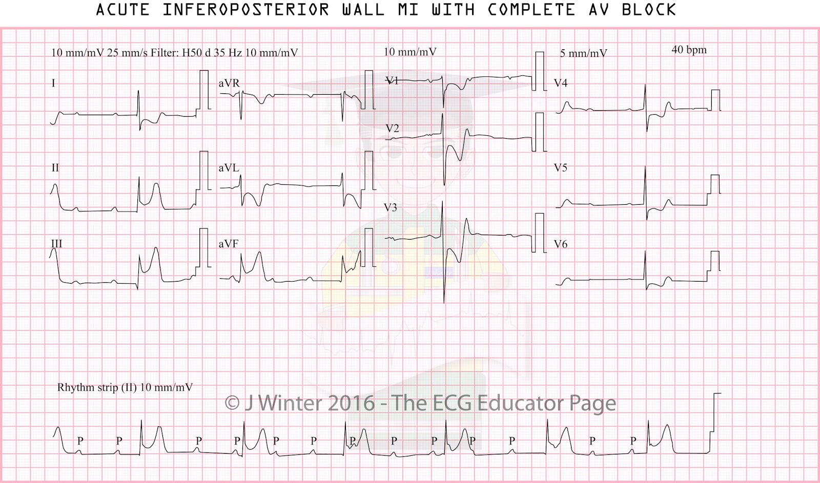 ECG Educator Blog : Acute Inferoposterior MI Examples