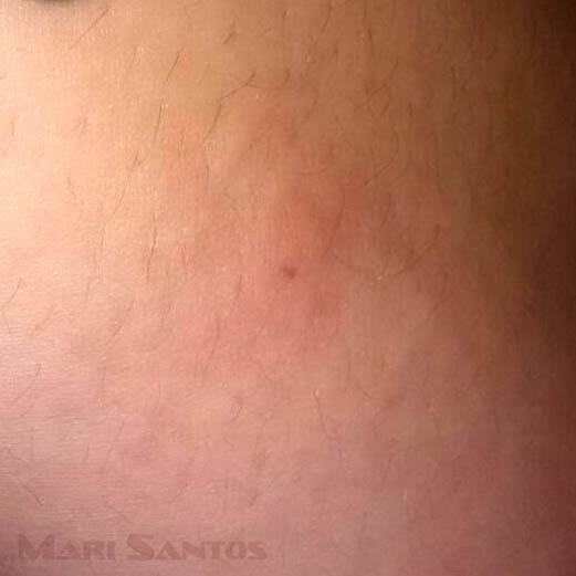 Reacao Alergica A Picadas De Percevejos