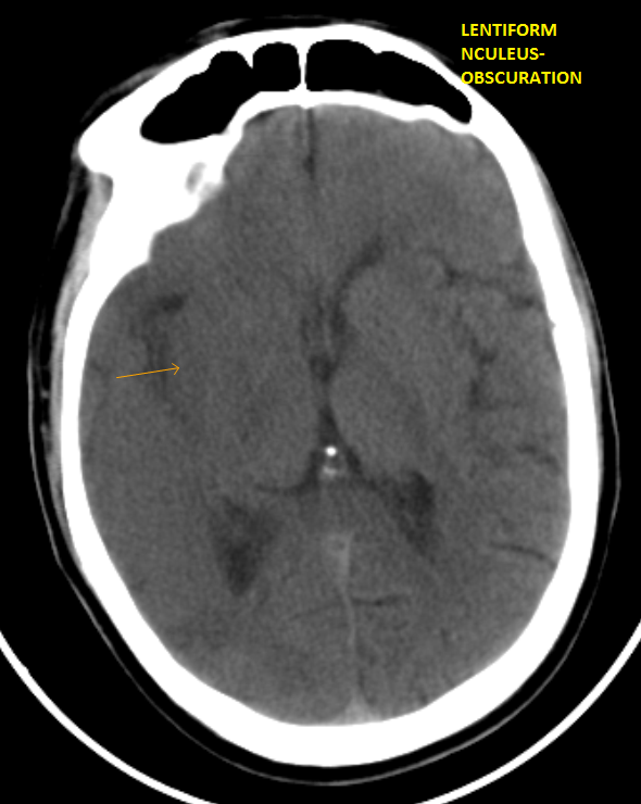 Hyperacute Infarction on NCCT - Sumer's Radiology Blog