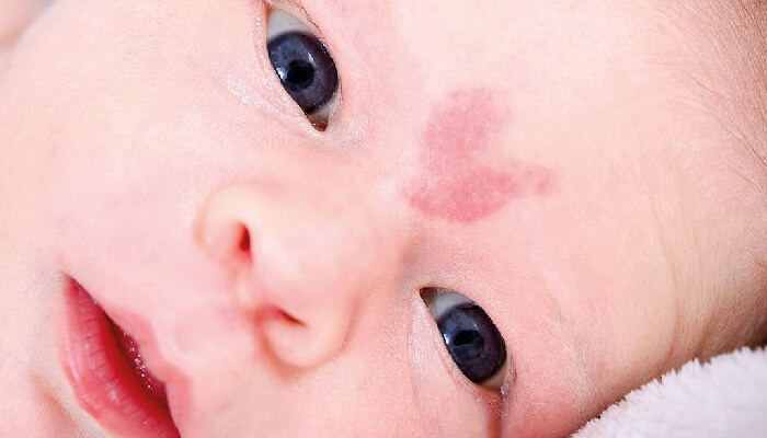 Apa Itu Tanda Lahir? Birthmark Toh