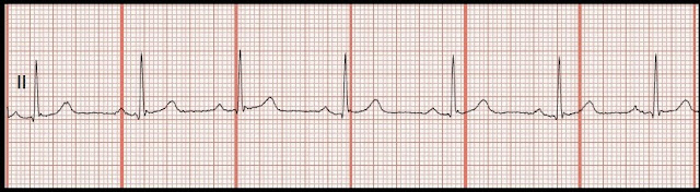 Practice EKG Rhythm Strips 218
