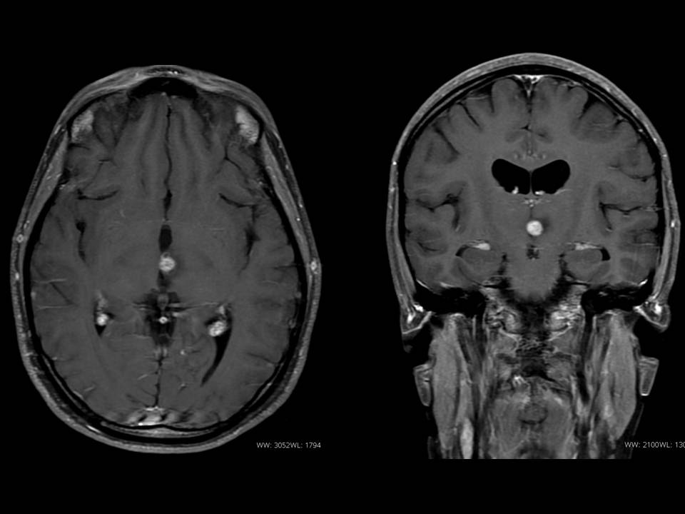 Radshare: Cavernous Angioma of Brain