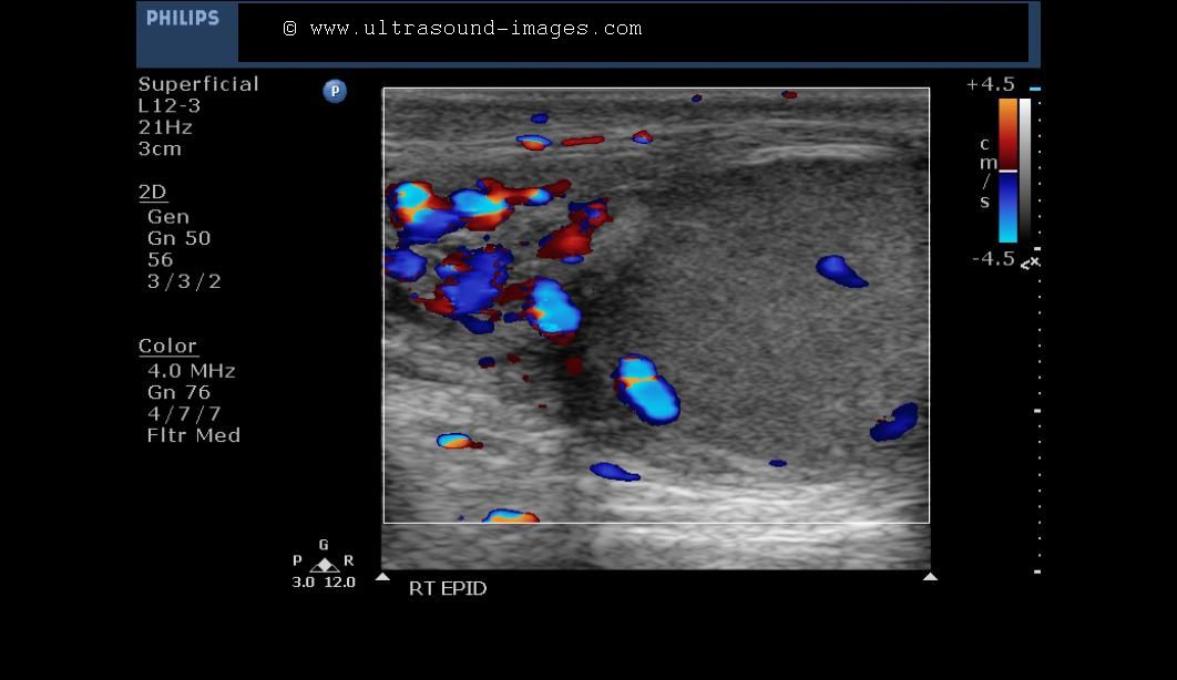 Epididymitis Ultrasound