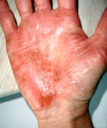 Dermatitis Pain Management - NIC NOC - Nursing Notes