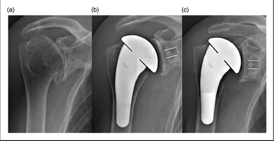 Shoulder Arthritis / Rotator Cuff Tears / Shoulder Pain : Short humeral ...