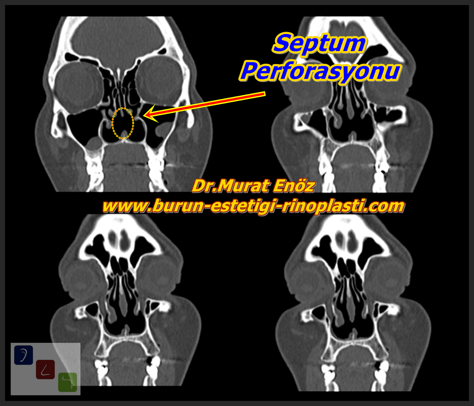 Nazal Septum Perforasyonu - Tanımı, Belirtileri ve Tedavisi