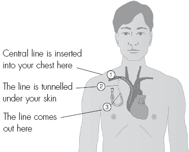 Tunneled Catheter Insertion - Your Only Guide - Tunneled Catheter ...