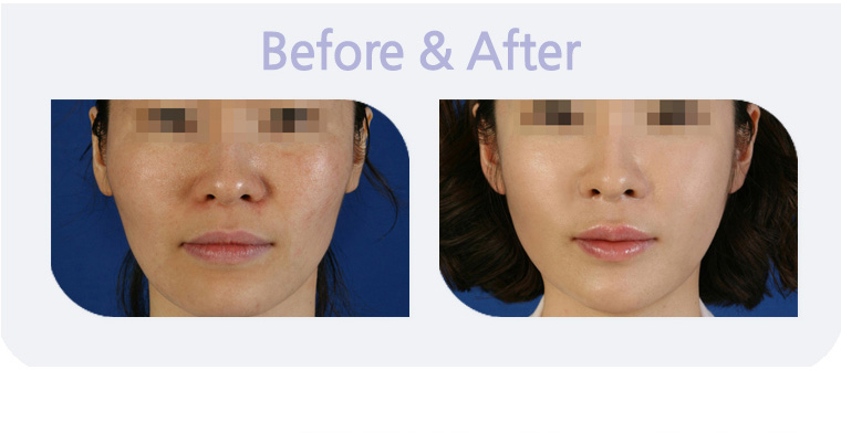 Eyelid Surgery Legend Dr. Kim Byung Gun: [BK Plastic Surgery Hosptial ...