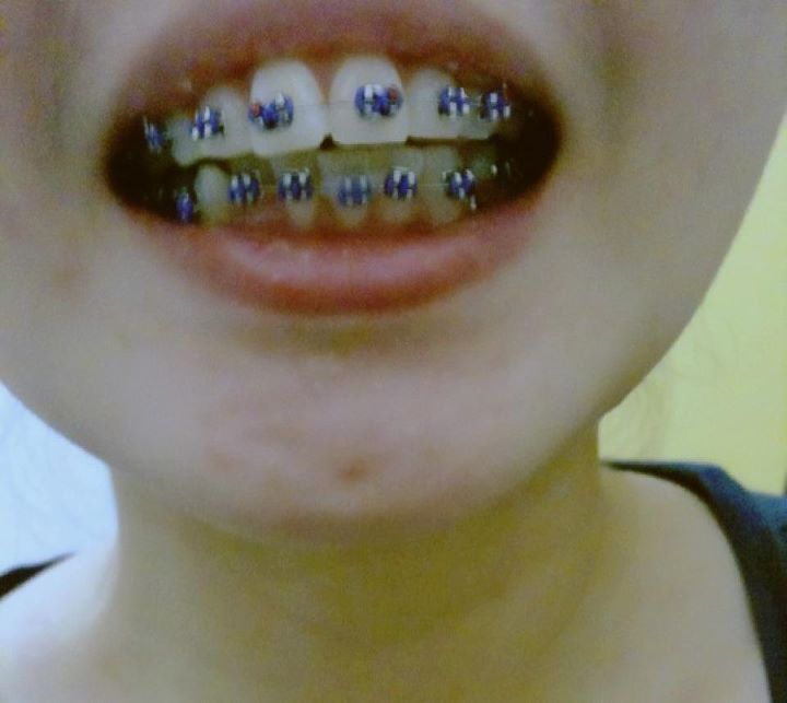 shereenwong88: First Month Teeth Braces