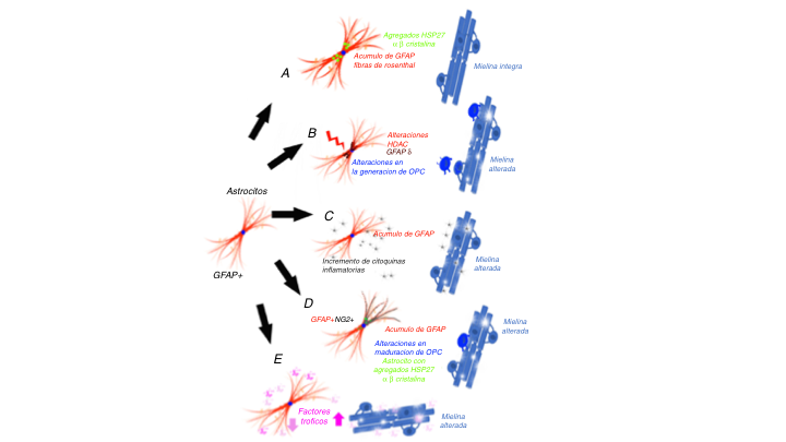 Esclerosis-Multiple-MSblog: Adult-onset Alexander disease ...