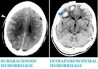 Intraparenchymal Hemorrhage With Midline Shift