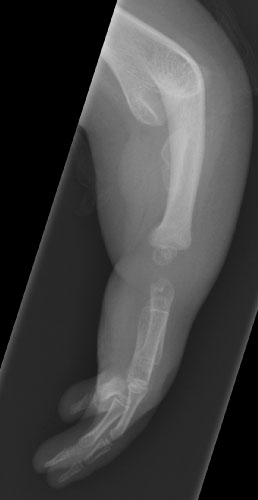 Ulnar deficiency, considerations for surgery | Congenital Hand and Arm ...