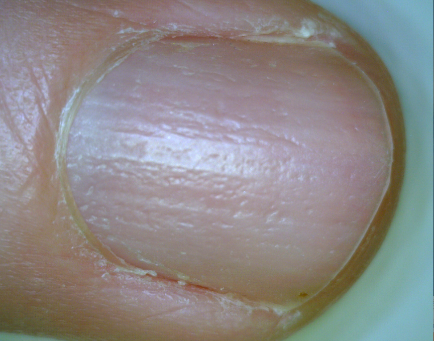 Nail pitting: Nail pitting causes