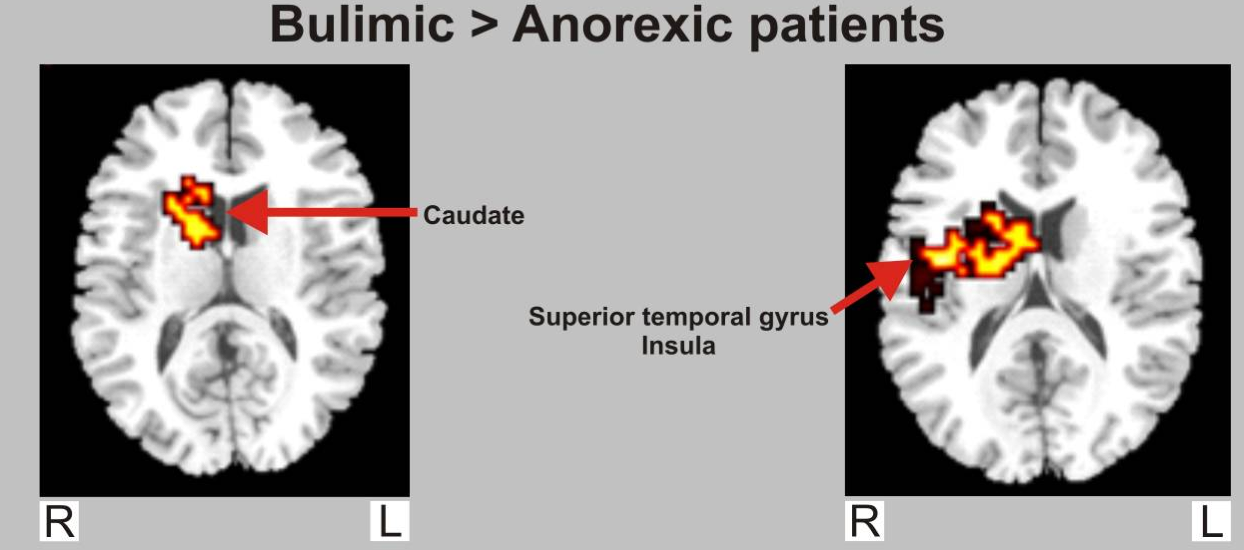 Neurociencia XXI: Brain Response to Food in Anorexia vs Bulimia