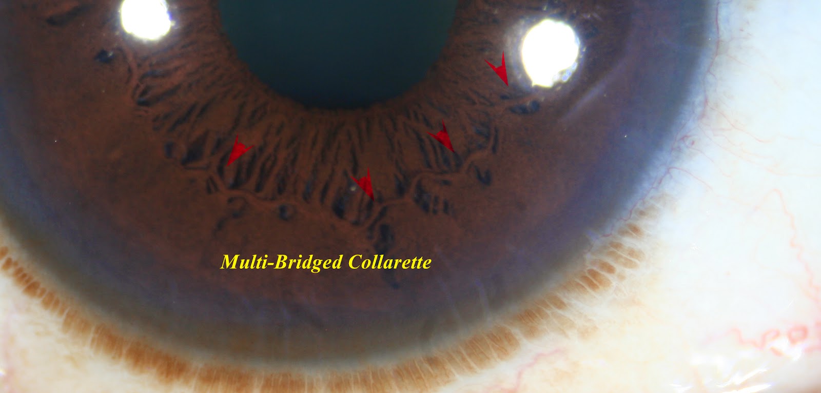 Modern & Multidimensional Iridology: Multi-Bridged Collarette - Rx - (surp)