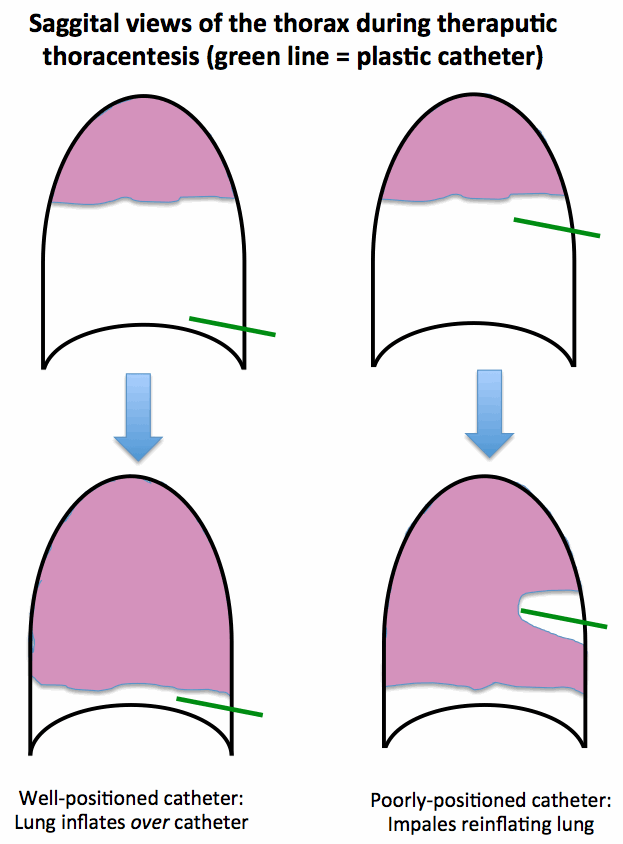 Pneumothorax ex vacuo: Post-thoracentesis pneumothorax in the ...