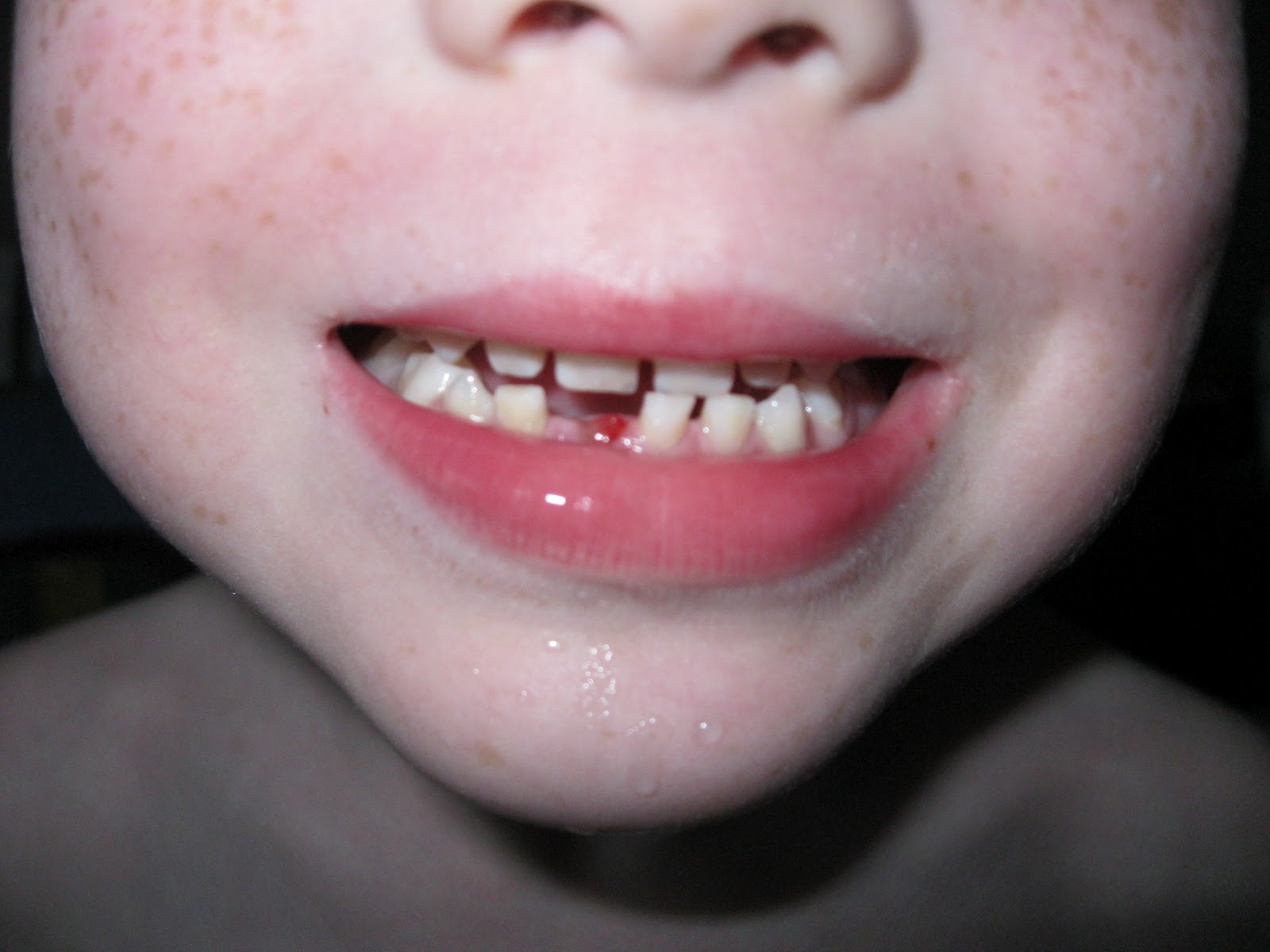 Weston & Wyatt: Weston Lost His First Tooth!!