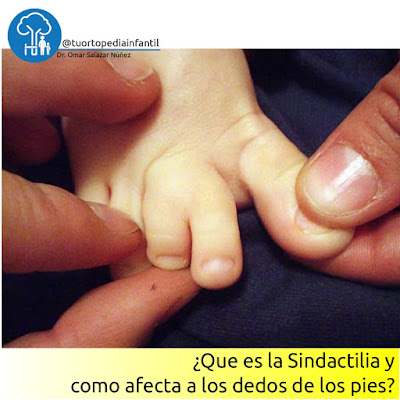 ¿Que es la Sindactilia y como afecta a los dedos de los pies?