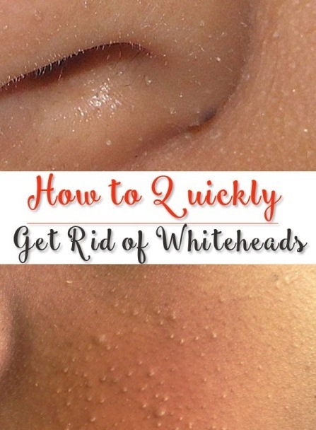How To Get Rid Of Whiteheads Healthy Mom how-to-get-rid-of-whiteheads-healthy-mom