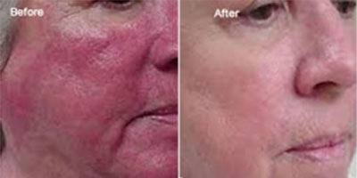 Selston Cosmetic Clinic: Rosacea - Facial Flushing & Redness ...