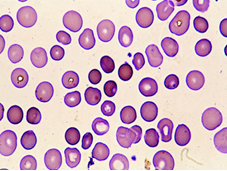 FICHERO DE HEMATOLOGÍA: ANORMALIDADES ERITROCITARIAS. Anormalidades en ...