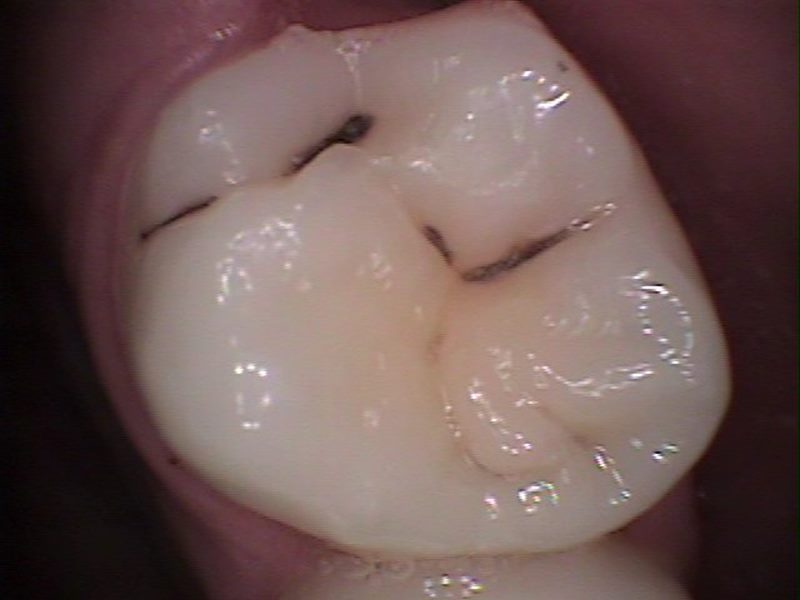 RESPUESTAS ODONTOLOGICAS: ¿QUE ES CARIES DENTAL?