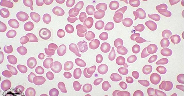 Células Sanguíneas: Anisocitosis