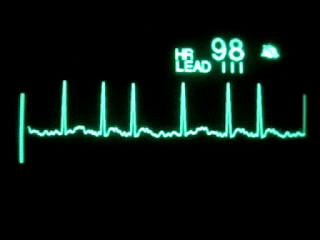 ELECTROCARDIOGRAFÍA BÁSICA PARA ENFERMERÍA: noviembre 2018