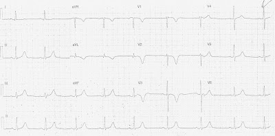 ECG of the Week: ECG of the Week - 6th June 2016 - Interpretation