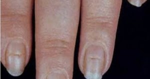 Horizontal ridges on fingernails vitamin deficiency - Awesome Nail