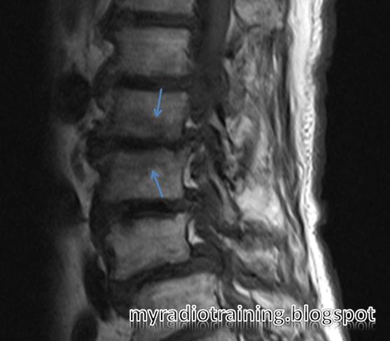 Radiology info hub: Modic changes in MRI