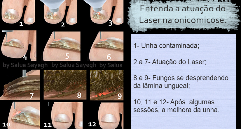 Sálua Sayegh Podologia - Vitória : A atuação do Laser na onicomicose ...