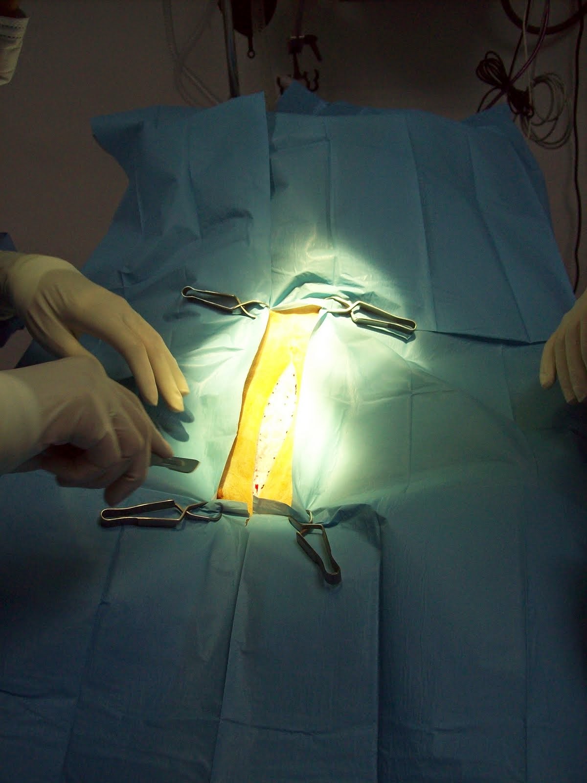 Enfermería Quirúrgica: Pre-Operatorio