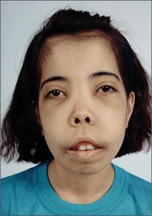 Thalassemia Awareness Campaign: Thalassemia: Signs and symptoms