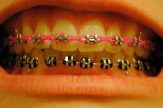 Ortodoncia : Ligas en los Brackets