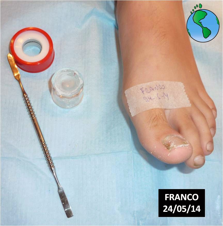 PODOLOGIA: LOS PIES SOBRE LA TIERRA #homeconsultingroom: ONICOCRIPTOSIS ...