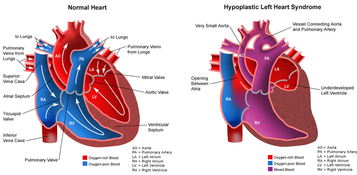 Shawn: Heart of a Warrior: About HLHS