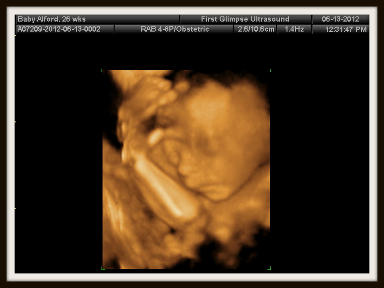 Us + Two: 25 Weeks 6 Days- 3D Ultrasound