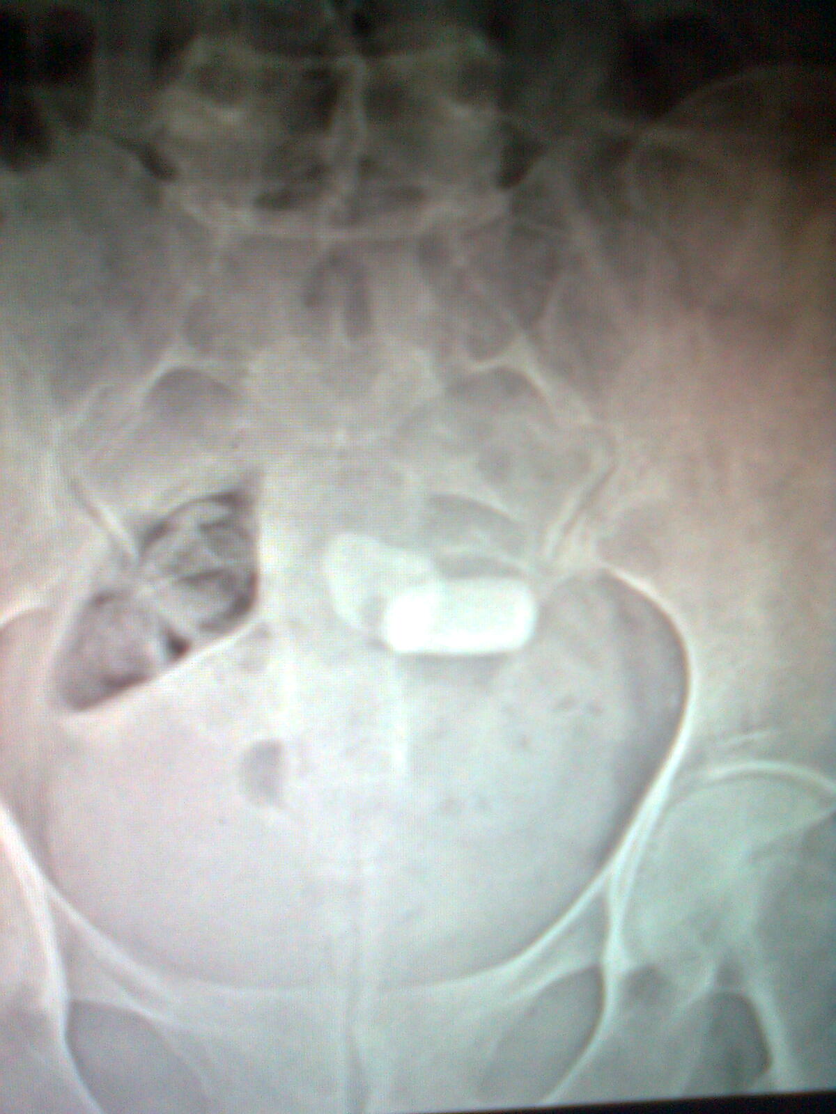 FOCAL SMALL BOWEL STRICTURE WITH SAIO & ENTEROLITHS - Sumer's Radiology ...