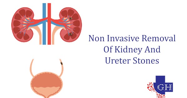 Non Invasive Removal Of Kidney And Ureter Stones