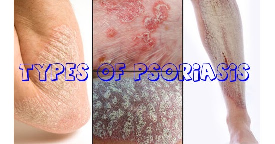 Types of Psoriasis | What Types of Psoriasis are There?
