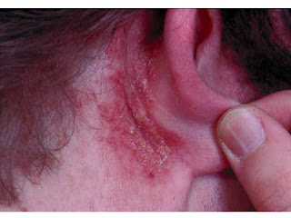 Consultations in Dermatology: The Groin Cracks Hailey Hailey Disease