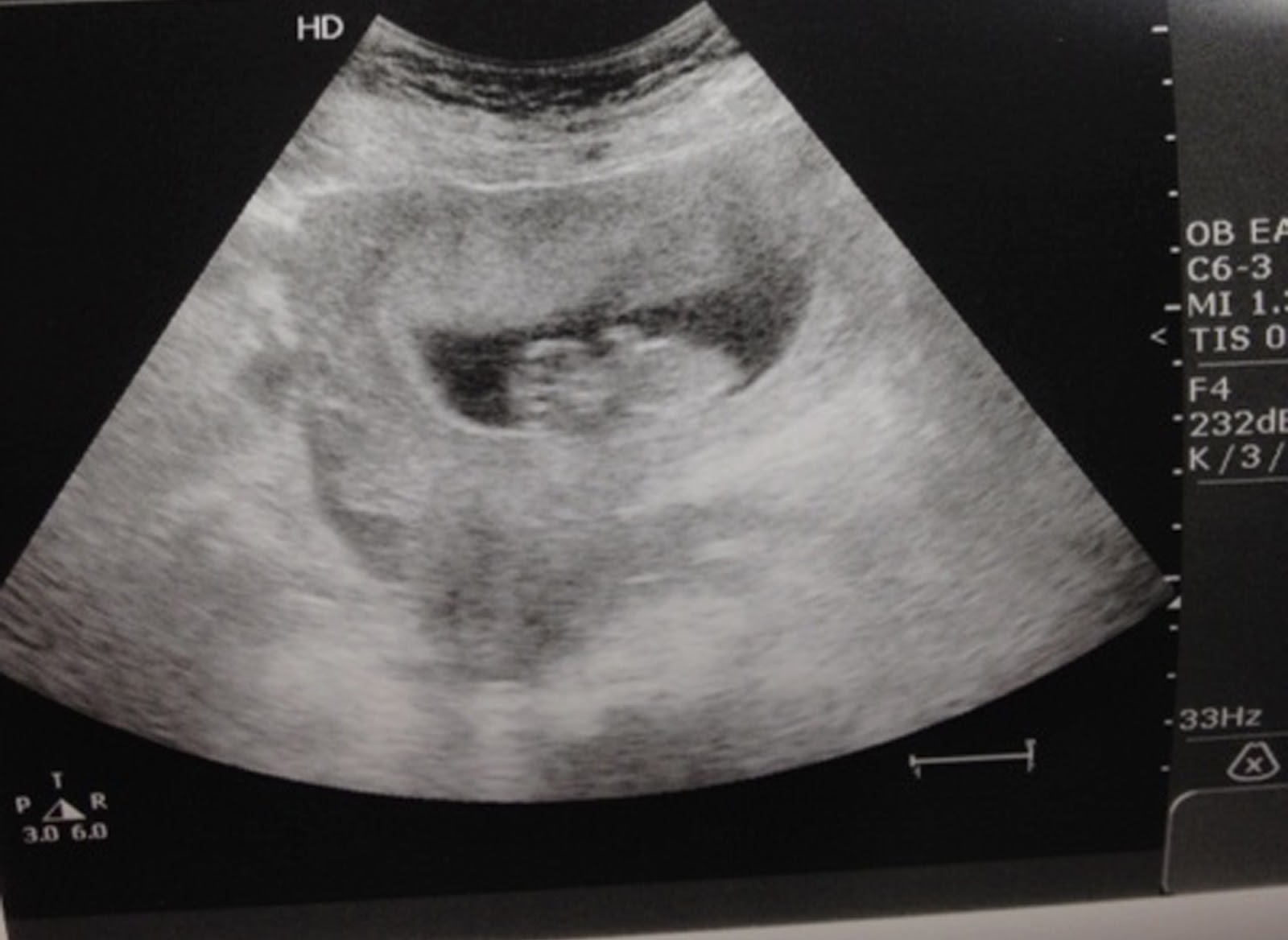 Top Notch Material: my pregnancy with hyperemesis gravidarum