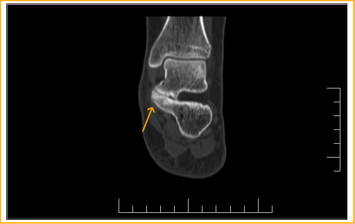 Subtalar talocalcaneal coalition-CT - Sumer's Radiology Blog