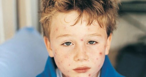 Afla totul despre boala numita pojar la copii | Mama buna