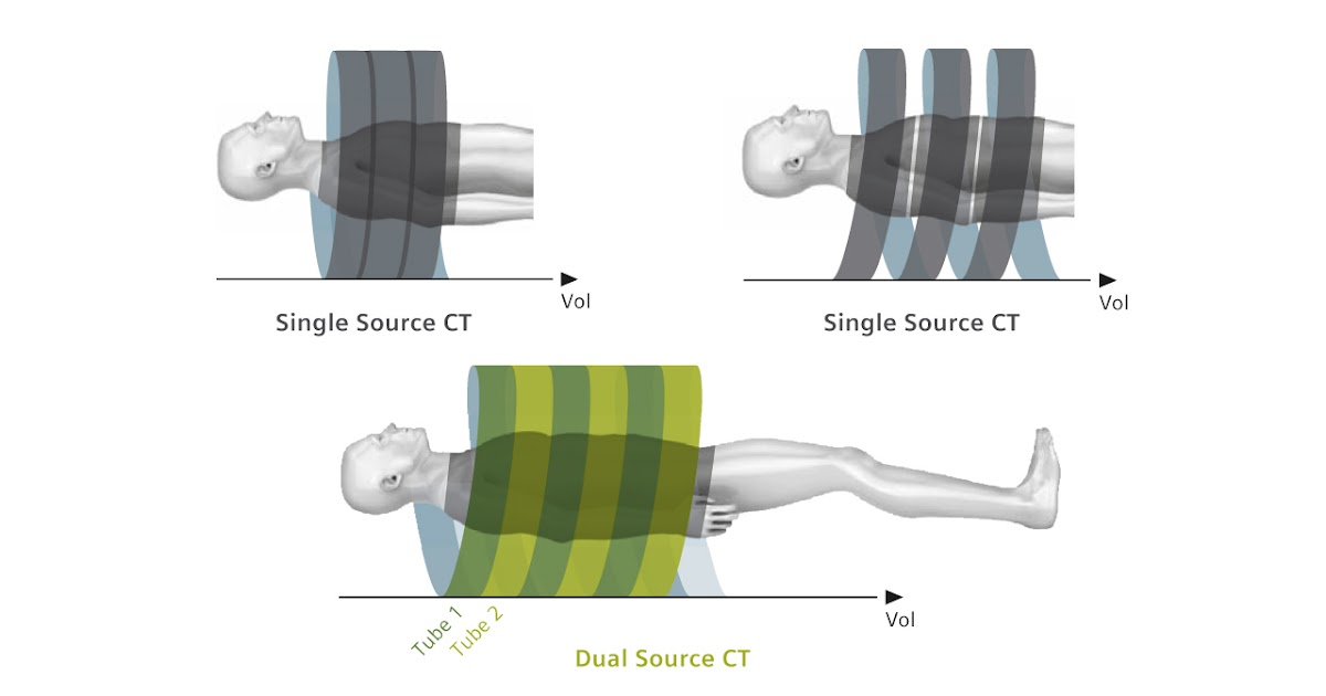 Radiation Therapy Instrumentation: CT SCAN : Different Variations of CT ...
