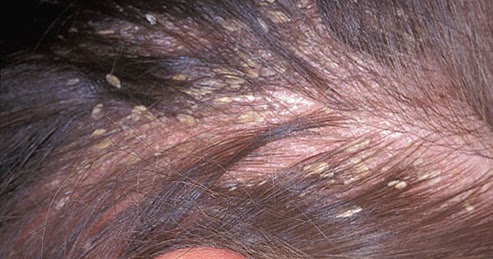 Caspa Severa - Remedios Para Controlarla y Prevenirla - Tratamiento ...