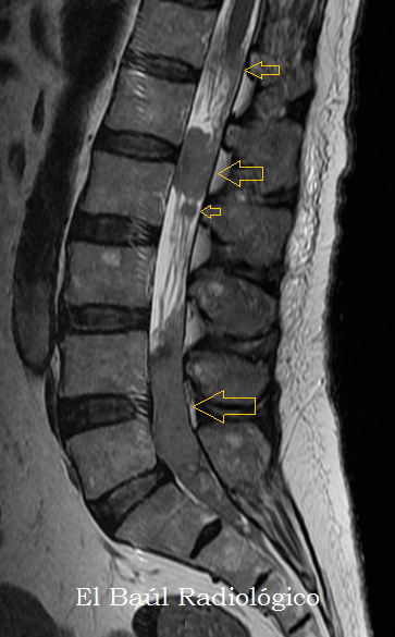 El Baúl Radiológico: 3) "DROP" METÁSTASIS. DISEMINACIÓN METASTÁSICA ...