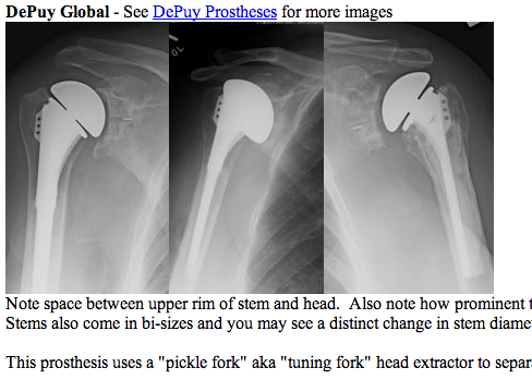 Shoulder and Elbow Surgery: Identifying the implanted shoulder ...