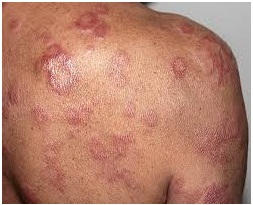 Various types of Kushtha and modern co-relation by Prof. Satyendra ...